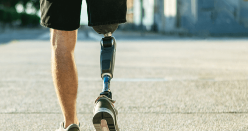 Prosthetics technology - spotlight on the Biometric foot | RWK Goodman